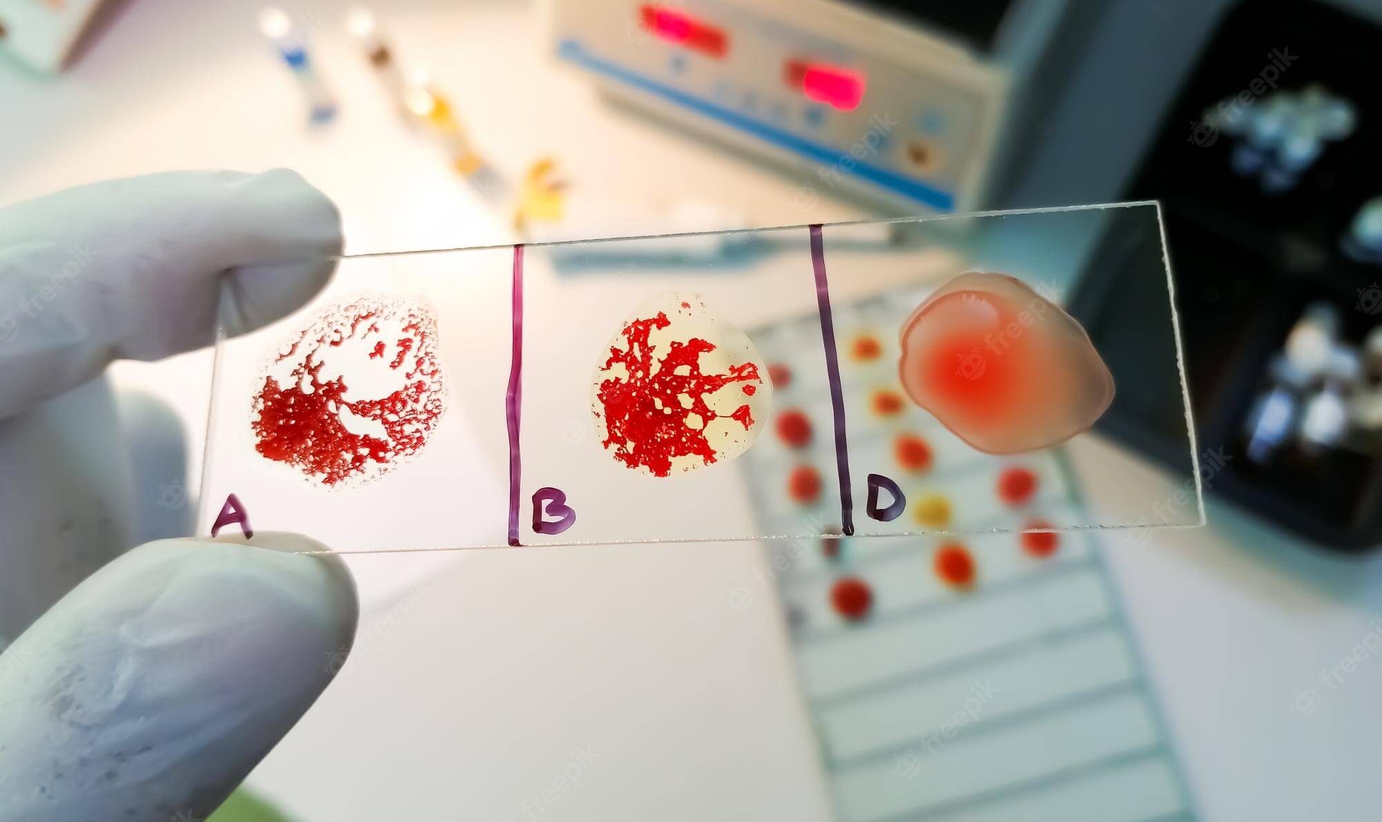 آزمایش گروه خون برای ازدواج - آزمایشگاه آنالیز شیراز